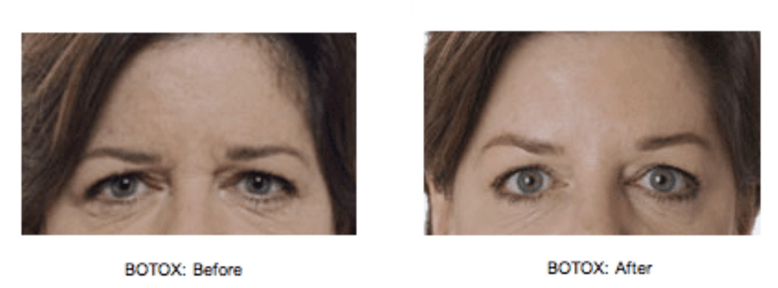 BOTOX® in Charlotte, NC | Evolve Medical Associates